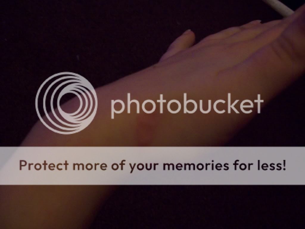 Retic bite!!!!!!!!!!! | Reptile Forums